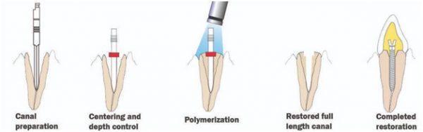 Luscent® Anchor Kit – Charles B. Schwed Co., LLC.